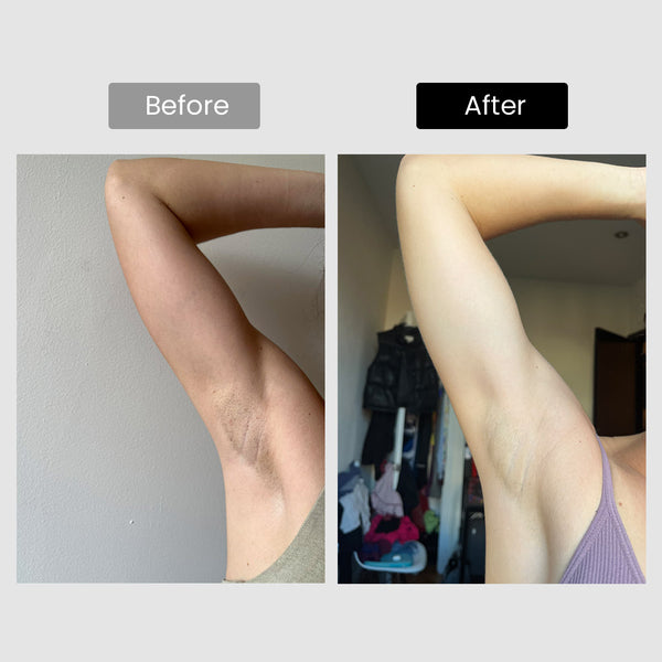 FDA Approved 810nm Diode Laser Hair Removal for Whole Body at Home